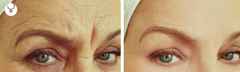 ¿Cómo rejuvenecer el tercio superior del rostro?